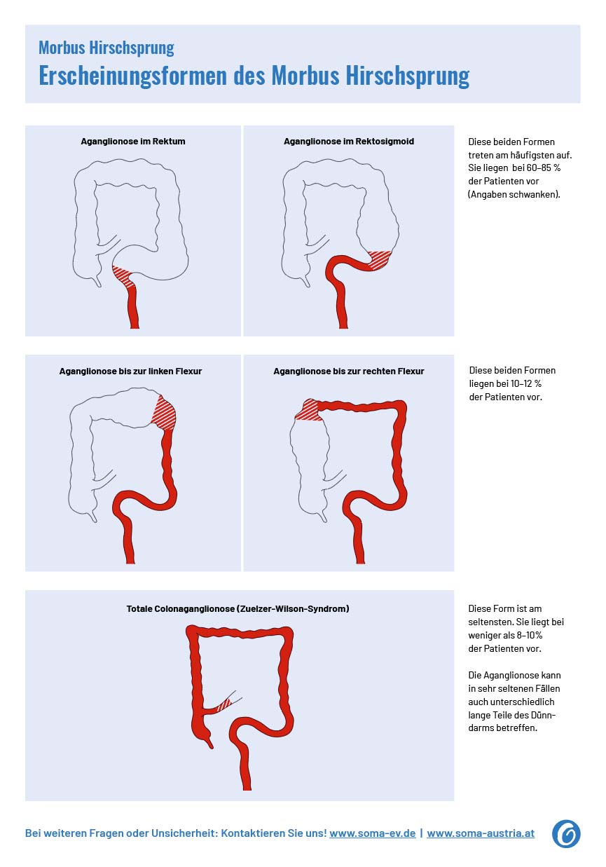 Morbus Hirschsprung - Alle wichtigen Infos
